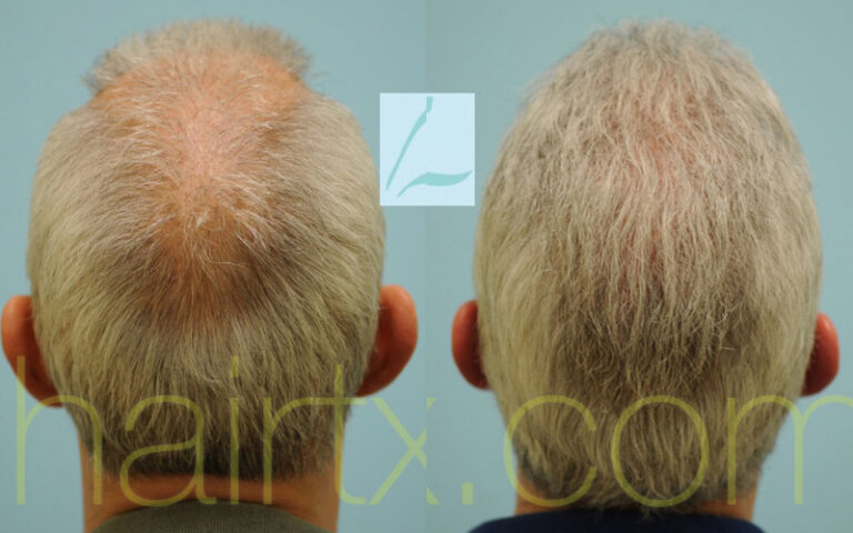 Plug & Slot Deformity Correction with Strip Harvest & Beard FUE Hair ...